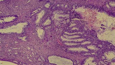 Minimal Deviation Adenocarcinoma Of The Cervix Still A Gynecologist