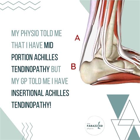 Achilles Tendinopathy Faraz Sethi