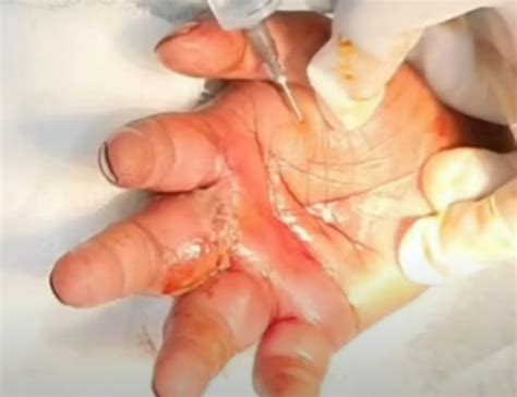 Hand Abscess Incision And Drainage Archives New Pimple Popping Videos