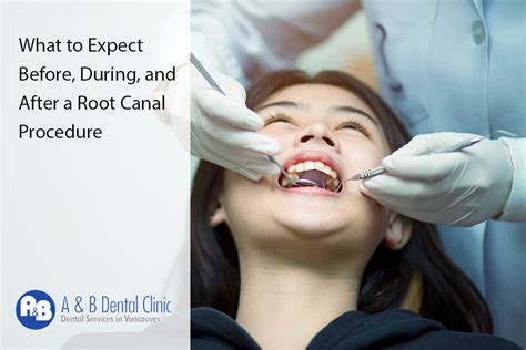 What To Expect Before During And After A Root Canal Procedure Ab Dental Clinic