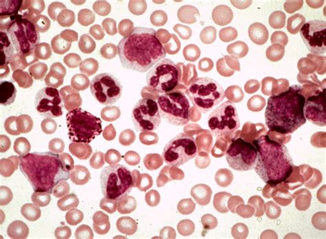 Myeloproliferative Disorders Causes Symptoms And Treatment