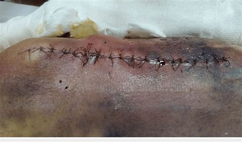 Wound Inspection 24 Hours After Left Proximal Tibia Open Reduction
