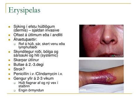 Ppt Streptococcal Sýkingar Powerpoint Presentation Free Download