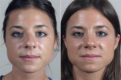 Bulbous Nose Job Before And After Nathanael Villa