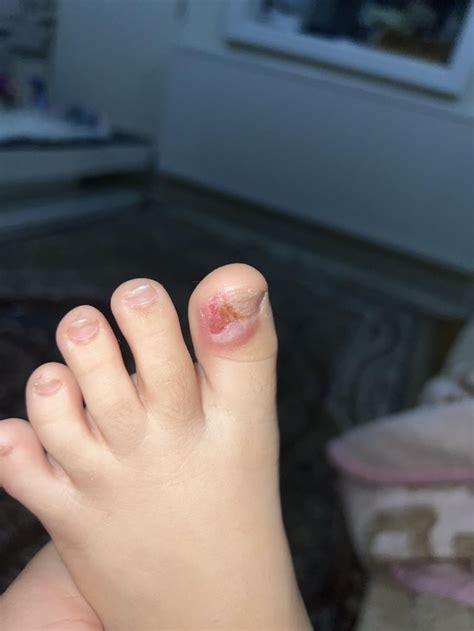 Infected Toe