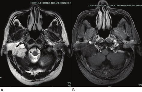 Brain Mri Before Surgery A T2 Weighted Axial Mri Showing