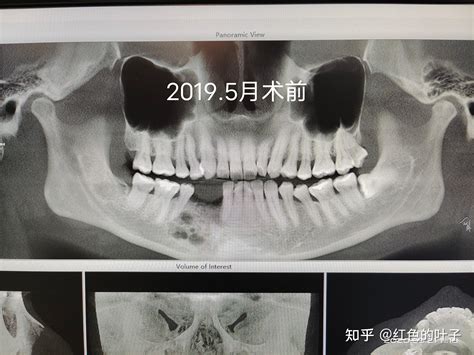 分享一下成釉细胞瘤的一些患病经历 知乎