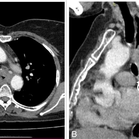 Ct Scan Axial A And Sagittal B Views Showing Circumferential