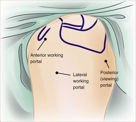 Arthroscopic Subacromial Decompression And Distal Clavicle Resection