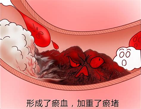 瘀血不去，新血不生，一个方子，活血养血，让你祛瘀新生 哔哩哔哩