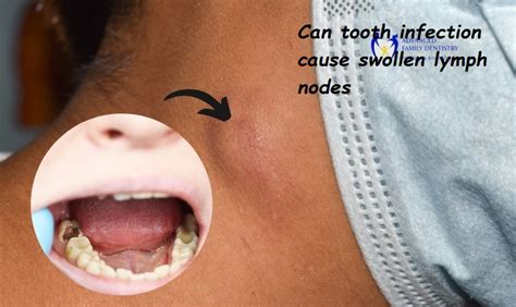 Can Tooth Infection Cause Swollen Lymph Nodes