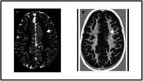 A Nnu Net Based Automatic Segmentation Of Fcd Type Ii Lesions In 3d
