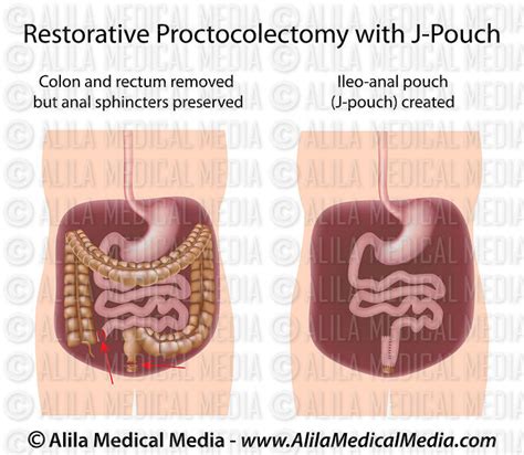 Alila Medical Media Right Hemicolectomy With Ileocolic Ileotransverse Anastomosis Medical