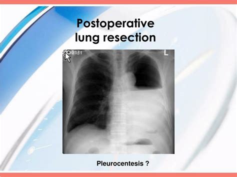 Ppt Lung Resection Powerpoint Presentation Free Download Id 819564