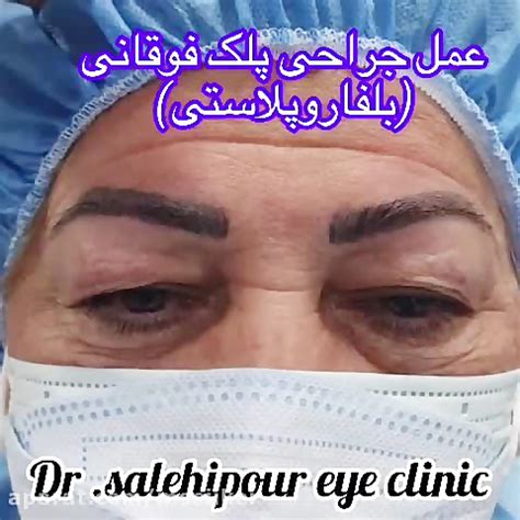 جراحی بلفاروپلاستی افتادگی پلک توسط دکتر مسعود صالحی پور در بندرعباس