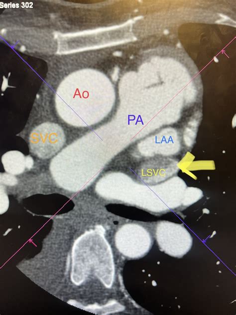 Ritu Thamman Md On Twitter Rt Bgheyath Ct Of Type 1 Unroofed