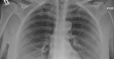 Emergency Medicine Visual Diagnosis Diagnosis Perforated Viscus
