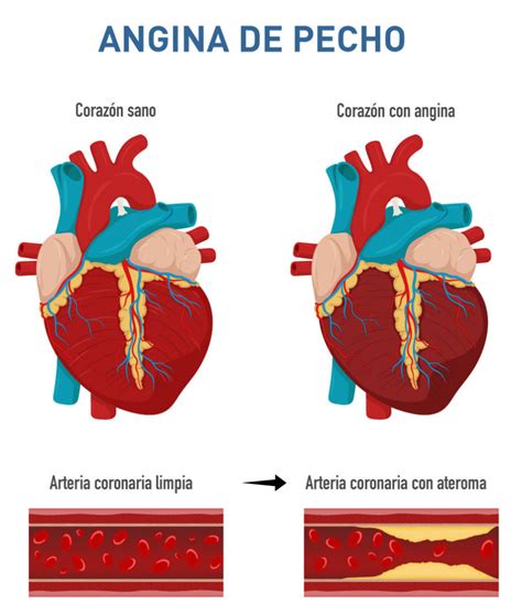 Por Que Se Produce La Angina De Pecho Y Cuales Son Sus Sintomas