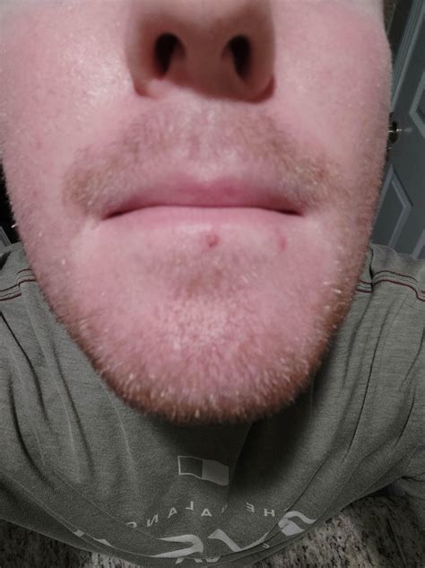 Anyone Only Get Acne Around The Lips And Not Anywhere Else So
