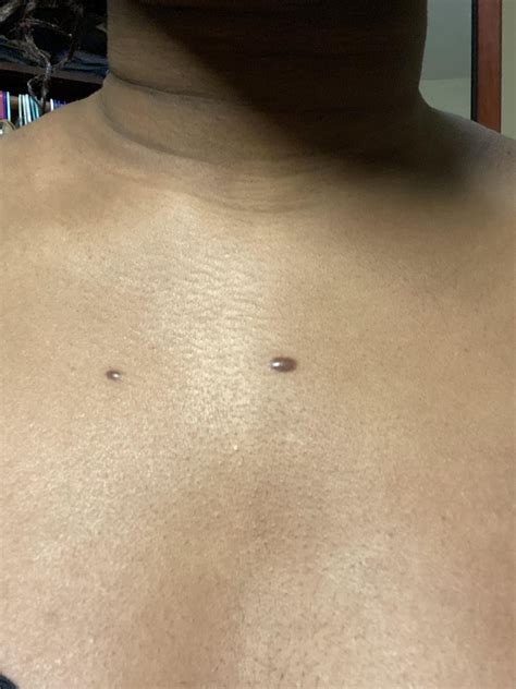 Keloid Or Hypertrophic Scar Rkeloids
