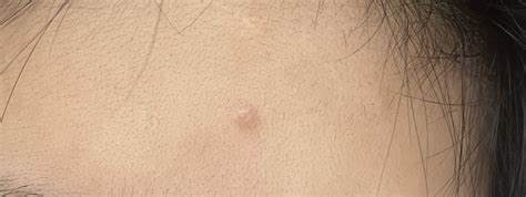 의사에게 물어보세요 이마에 이렇게 한개 강남언니 1등 성형수술and피부시술 정보앱