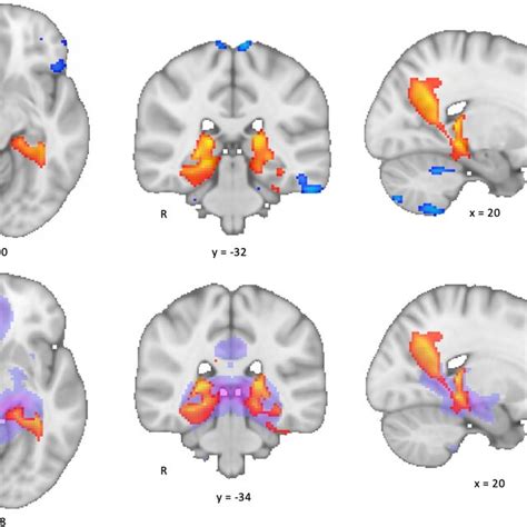 Ms Lesion Locations Associated With Memory Dysfunction Overlap An A Download Scientific Diagram