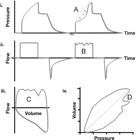 Figure 2 From Ventilator Waveforms Semantic Scholar