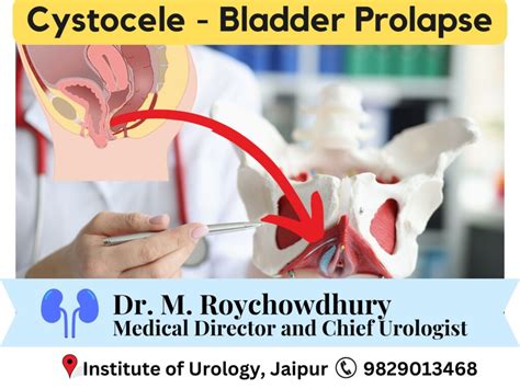 Cystocele Understanding And Managing Bladder Prolapse