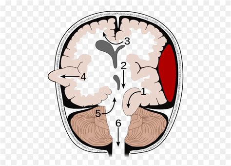 Increased Intracranial Pressure Monroe Doctrine Clipart Flyclipart