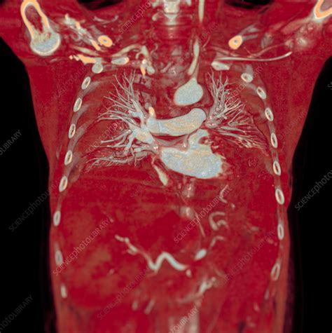 Pulmonary Artery Ct Scan Stock Image F0377292 Science Photo Library
