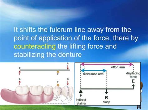 Component Parts Of A Partial Denture Pptx