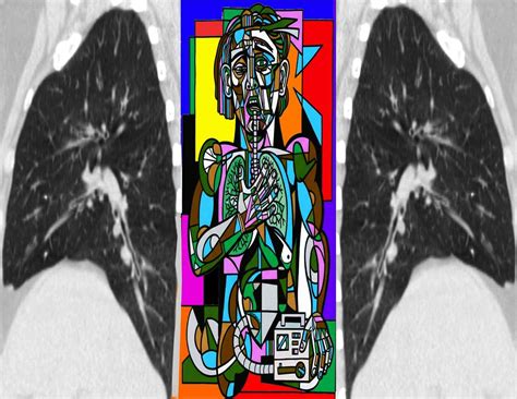 Finding Lungs Bronchial Wall Thickening The Common Vein