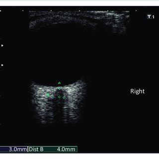 Ultrasound Optic Nerve Sheath Diameter Onsd Measurements Compared