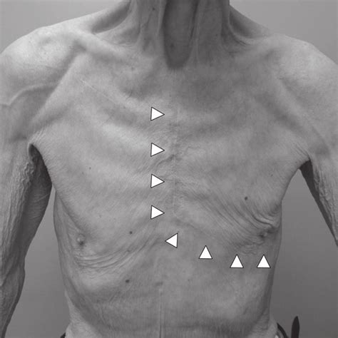 The Patients Chest Displaying A Left Hemi Clamshell Incision Arrows