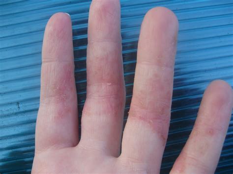 Моя история лечения экземы на руках с фото и рекомендациями