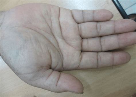 Reticulated Hyperpigmented Macules On A Dorsa Of The Hands B Dorsa