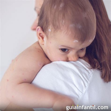 Cómo Diferenciar Sarampión Varicela Y Rubéola En Los Niños