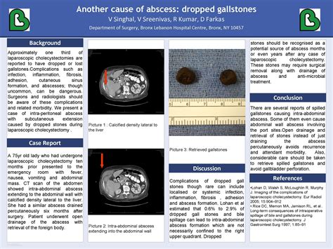 Another Cause Of Abscess Dropped Gallstones Sages Abstract Archives