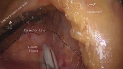 Laparoscopic Rectosigmoidectomy For Cancer Youtube