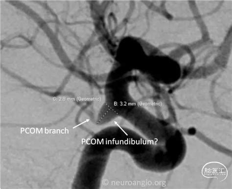 后交通动脉漏斗（pcoa Infundibulum） 脑医汇