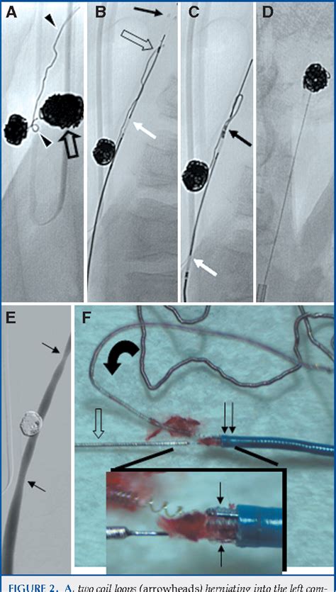 Figure 2 From Retrievable Closed Cell Intracranial Stent For Foreign