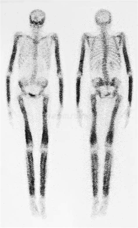 Bone Scan Stock Image Image Of Infection Sick Fractures