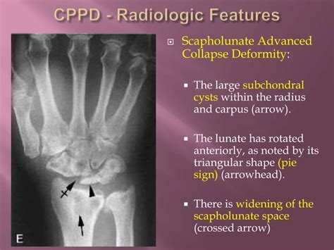 Metabolic Scurvy Gout Cppd Fluorosis Sayid Ppt