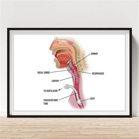 Tracheostomy Airway Tube Art Print By Science Photo Library Science