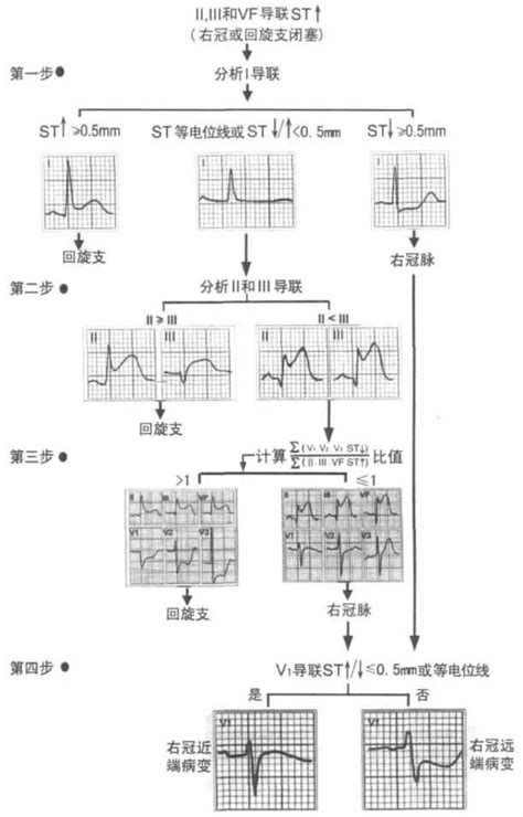 冠心病心肌缺血，如何用心電圖進行定位診斷？ 壹讀