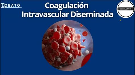 Coagulación Intravascular Diseminada 🩺 Cid Enarm Diagnóstico Y