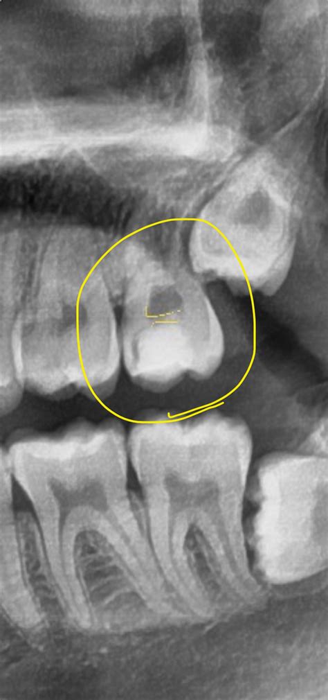Removing Second Molars Tooth Raskdentists