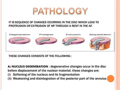 Pivd Ppt