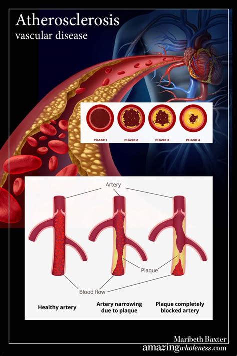 Vascular Health Arteriosclerosis Atherosclerosis Amazing