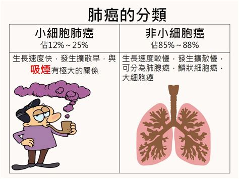 康善生技 【肺癌的分類】 👉肺癌可分為小細胞肺癌及非小細胞癌兩大類